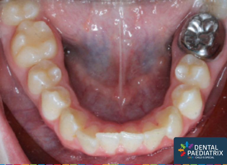 Hypomineralisation aka Chalky Teeth | Dental Paediatrix